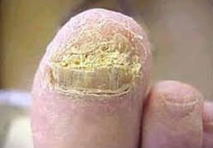 Give A Natural Remedy Recipe To Cure Nail Fungus With Chinese Herbal