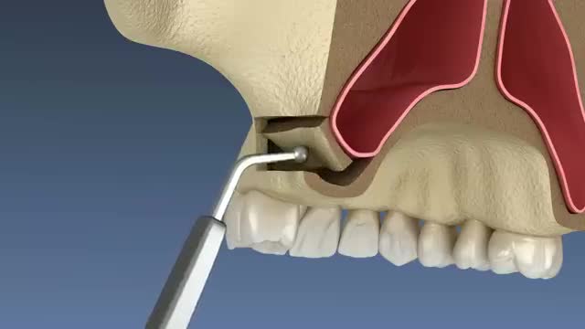 Realistic 3d dental animation 3d surgical explainer video 3d medical ...