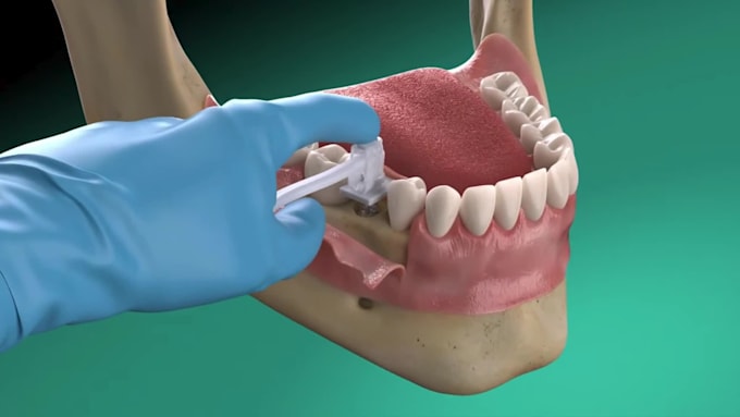Do 3d dental animation 3d medical device animation 3d dental implant ...