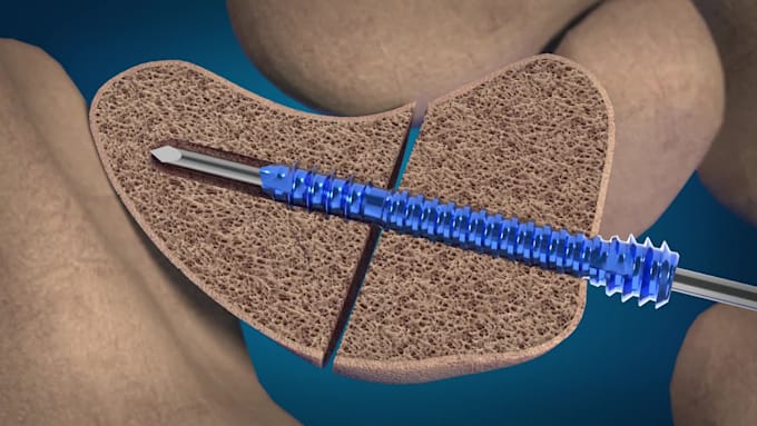 Create 3d medical animation, surgery animation, 3d medical video by ...