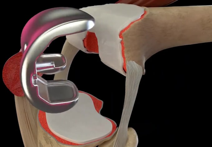 Do 3d medical, surgical sequence, 3d orthopedic animation, medical ...