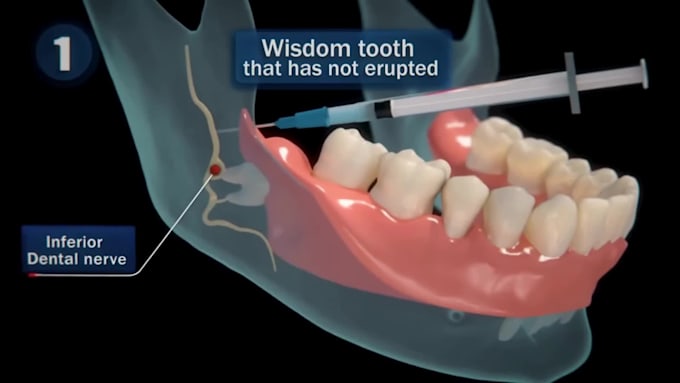 Do 3d dental animation 3d medical animation and wisdom teeth extraction ...