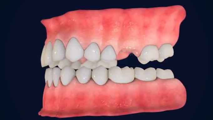 Build realistic 3d medical animation for dental procedure, teeth ...