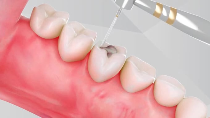 Do 3d medical animation 3d dental explainer video dental implant ...