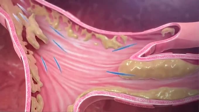 2d 3d medical animation, medical device animation, healthcare, surgical ...