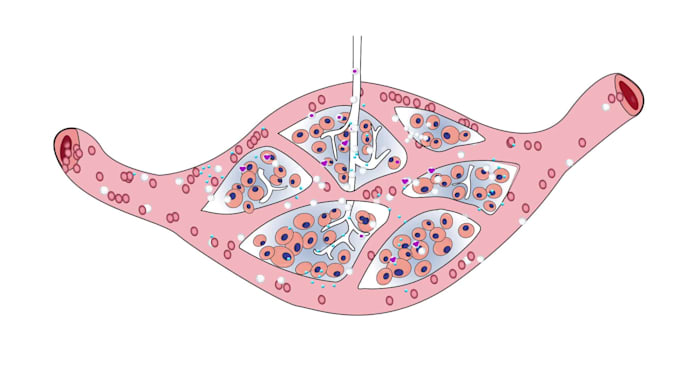 Draw a realistic scientific anatomical surgery illustration by ...