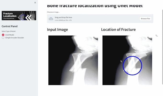 Bone fracture localization model by Ap539813 | Fiverr