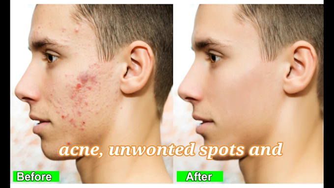 Professionally remove pimples,acne, and retouch your face by ...