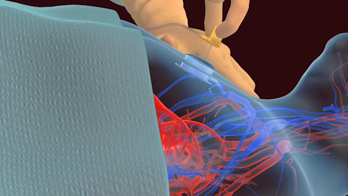 Do high quality medical animation medical virus surgery motion graphic ...