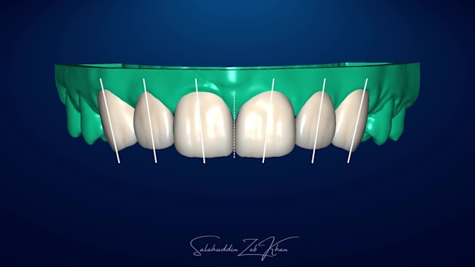 Do 2d and 3d digital smile designs for you using exocad by Caddentist ...