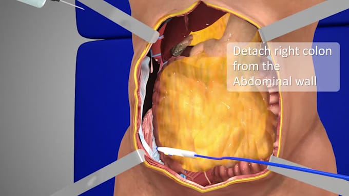 Make 3d animation medical animation 3d surgery animation medical ...