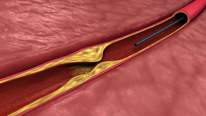 Medical product animation, medical device animation, medical device ...