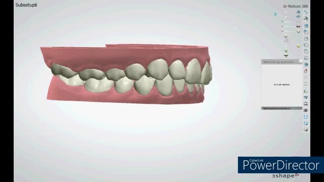Design dental crown bridge denture design using 3shape exocad by ...