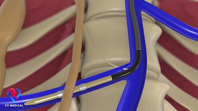 3d medical products animation, 3d scientific animation, medical device ...