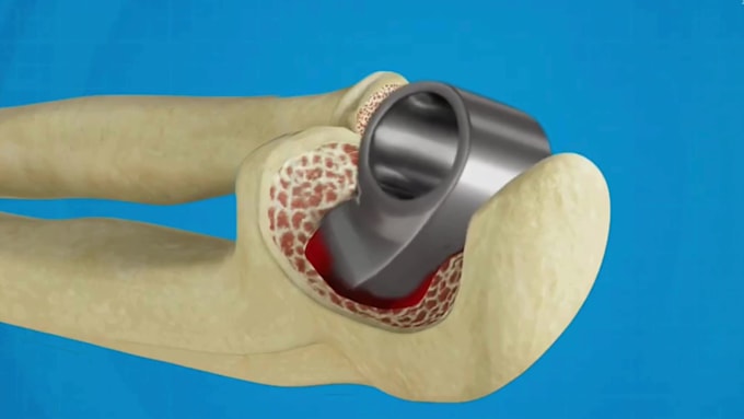 Create 3d surgery animation surgical procedure anatomy surgery ...