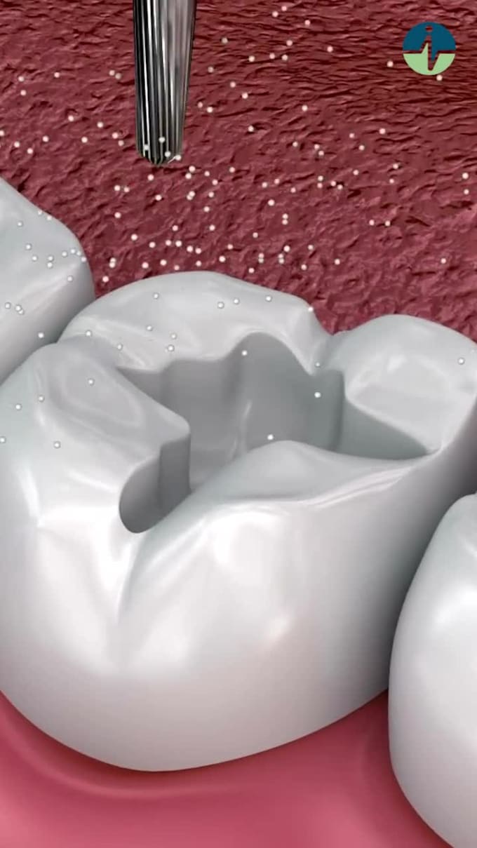 Do 3d dental procedures, surgery animation, 3d medical explainer video ...