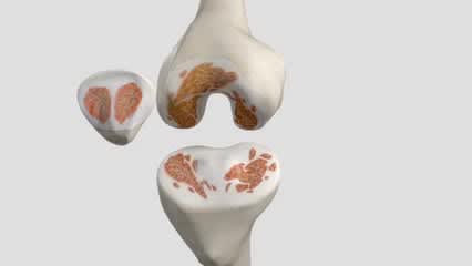 2d, 3d orthopedic animation, bone surgery animation, medical video by ...