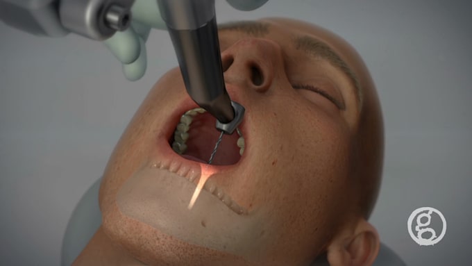 3d dental video animation, surgical procedure, 3d teeth animation by ...