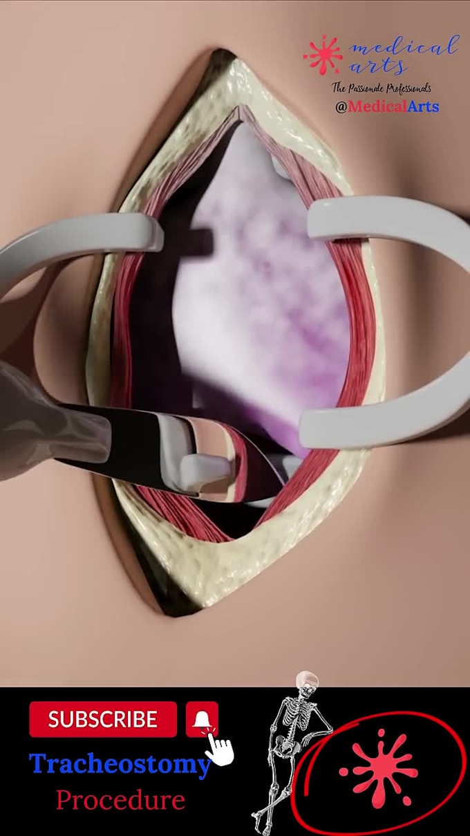 Do 3d medical device animation 3d surgical device animation 3d medical explainer by ...