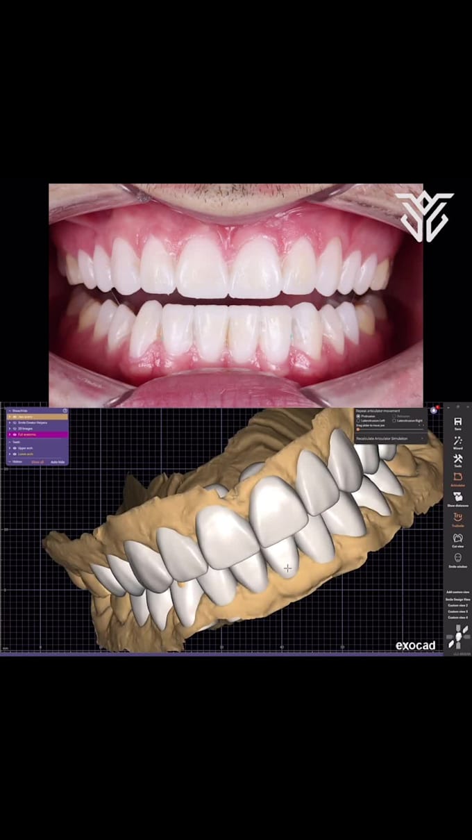 Design digital waxup and dsd by Yakout97 | Fiverr