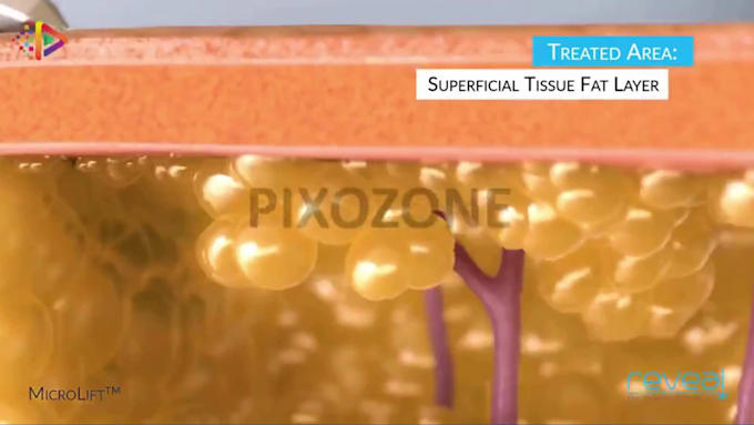 Do 3d medical animation, 3d surgery animation, 3d healthcare surgical ...