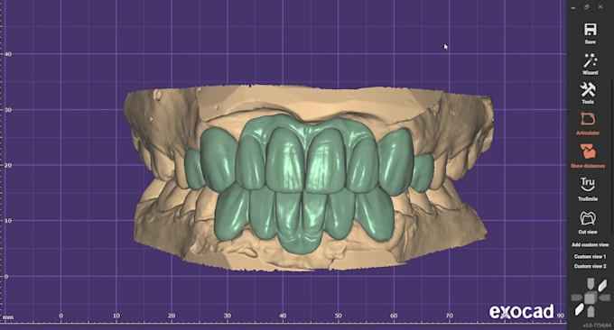 Design high quality dental restorations in exocad or 3shape by ...