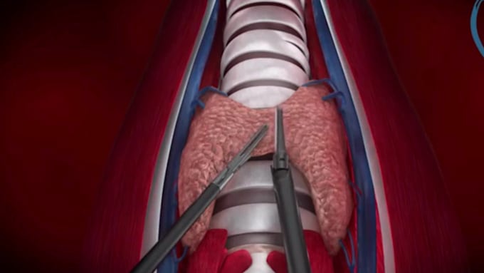 Create 3d medical animation video surgery explainer video by Olivia ...