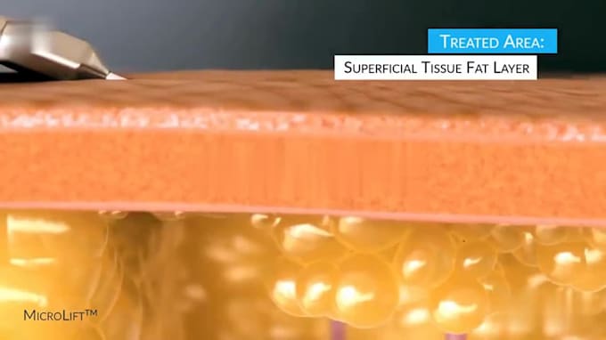 2d 3d medical animation, medical device animation, healthcare, surgical ...