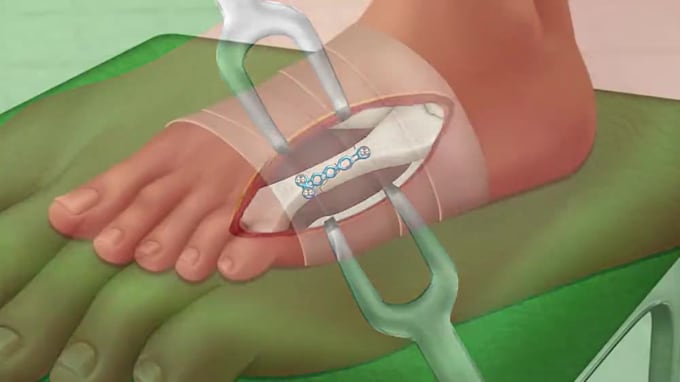 3d surgical video, 3d medical animation, 3d medical device, healthcare ...