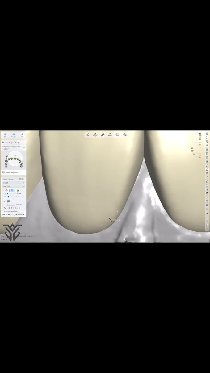 Design crown, bridge, and wax up using 3shape software by Yakout97 | Fiverr