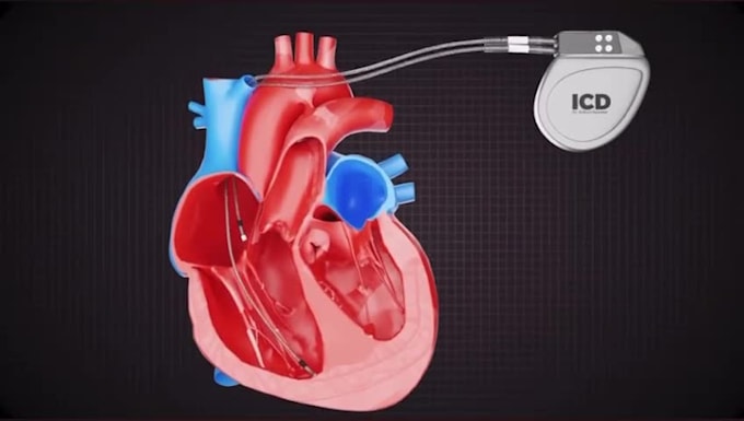 Do 3d medical device animation, 3d medical video, surgical animation ...