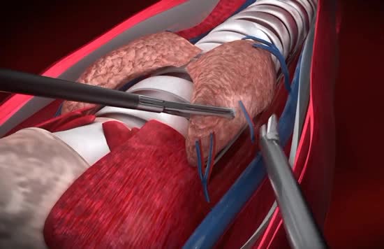 3d medical product animation video 3d surgery 3d health anatomy ...