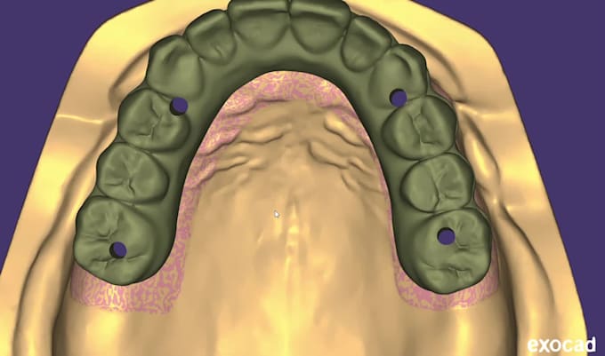 Be your certified exocad designer for dsd, veneers, implants, dentures ...