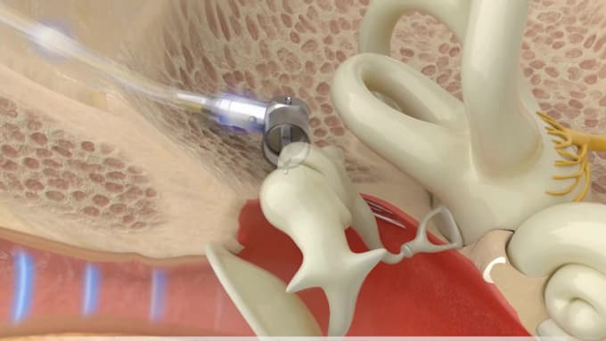 Create 3d medical animation medical explainer ear surgical procedure ...